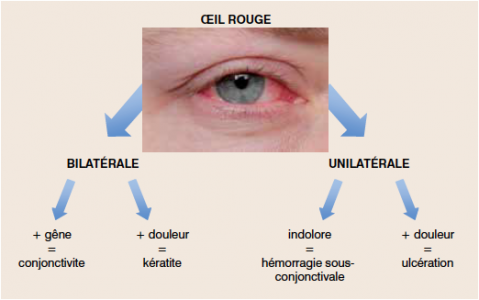 Sport et pathologies oculaires : savoir les reconnaitre