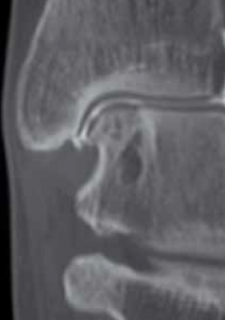 LODA ou Lésions ostéochondrales du Talus : De leur physiologie à leur ...