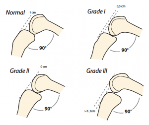 Partie 2 – La lésion du ligament croisé postérieur : quel traitement ...