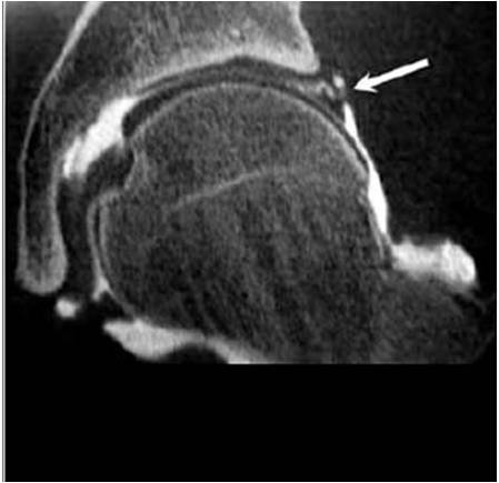 Lésion du labrum – La médecine du sport