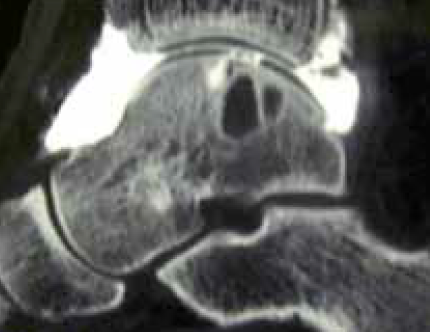 La forme G du Talus – La médecine du sport