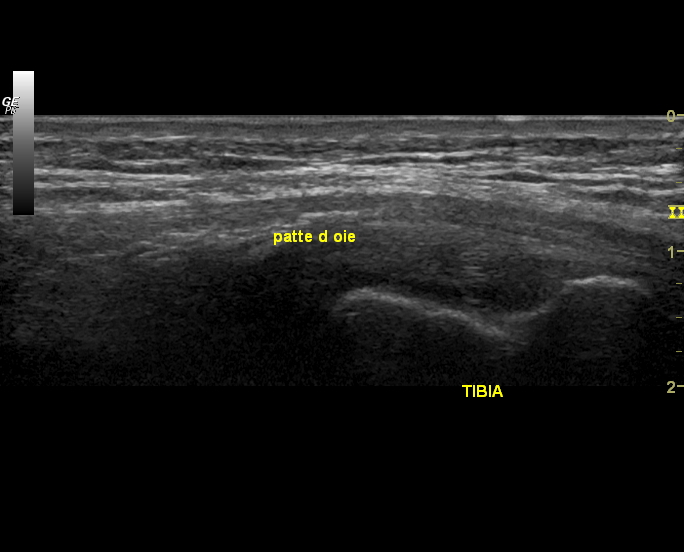 TENDINOPATHIES DE LA FACE POSTÉRIEURE DU GENOU | Forum Musclesenmetal