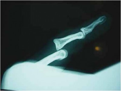 Lésions ligamentaires – Entorses et luxations des doigts longs – La ...