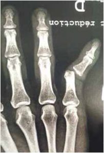 Lésions ligamentaires – Entorses et luxations des doigts longs – La ...