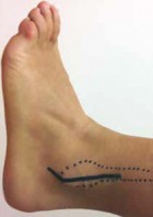 La luxation des tendons fibulaires : savoir évoquer le diagnostic ...