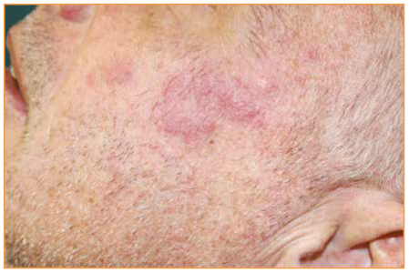 Lésion étendue érythémateuse au niveau du visage : quel est votre ...