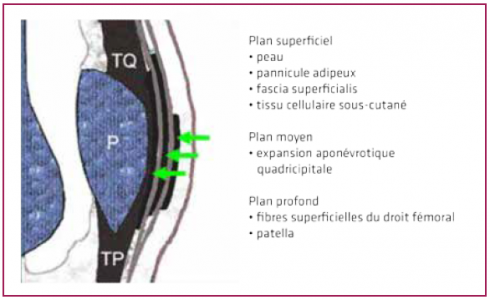 La pathologie prépatellaire, des problématiques diverses – La médecine ...