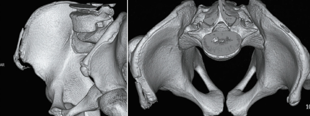 Avulsion de la crête iliaque chez un jeune sprinteur – La médecine du sport
