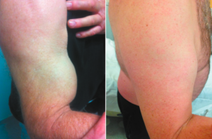 Rupture bilatérale du tendon distal du biceps brachial – Des séquelles ...