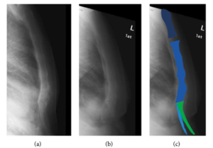 Les pathologies du thorax – Partie 2 – La médecine du sport